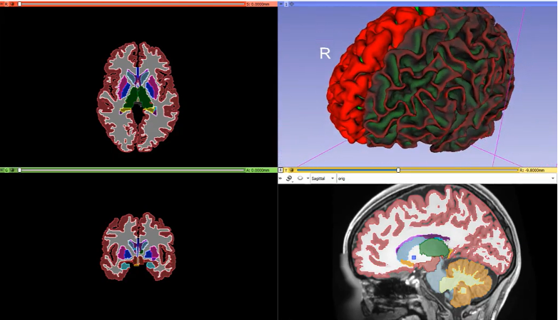 3D printed brain models for education and training - ICRAR